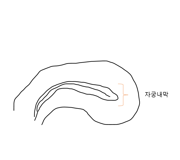 자궁내막 증식증이 무엇인가요 Endometrial Hyperplasia 네이버 블로그