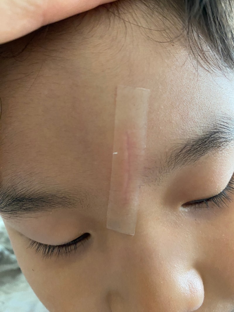 얼굴 흉터 연고소아봉합수술실밥 제거 후 흉터연고피부재생 연고수술자국 흉터 연고찢어진 상처 흉터 연고아이 꼬맨 상처