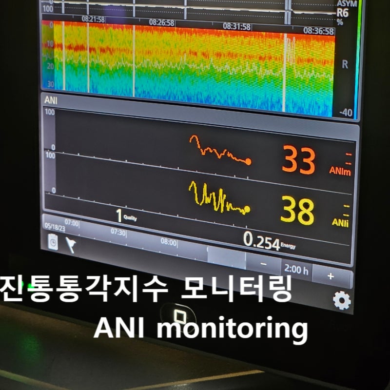 마취중 지속적 통증감시 진통통각지수 모니터링 (ANI monitoring) : 네이버 블로그