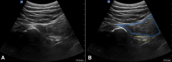좌골 신경 차단술(Transgluteal Sciatic nerve block)에 관하여. - 좌골신경 지배 부위, 수술 적응증과 ...