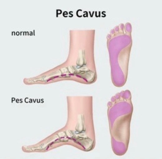 요족(Cavus foot)으로 인한 발바닥 통증 해결을 위한 스트레칭 및 근막이완 마사지 : 네이버 블로그