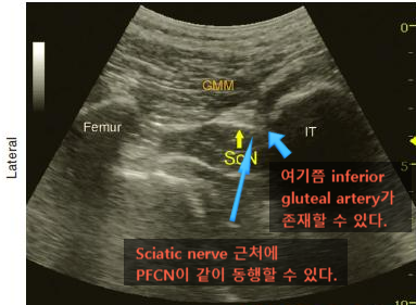 좌골 신경 차단술(Transgluteal Sciatic nerve block)에 관하여. - 좌골신경 지배 부위, 수술 적응증과 ...