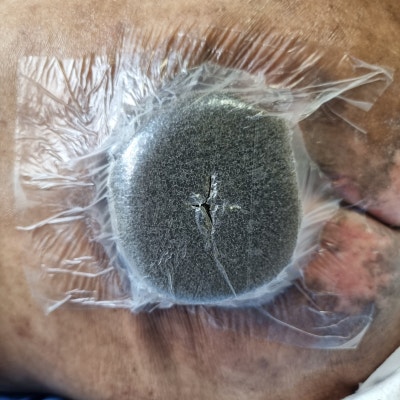 [방문간호] 집에서 욕창음압치료 생생후기 / Curasys / Curavac / NPWT / 큐라시스 / 실제욕창사진주의 ...