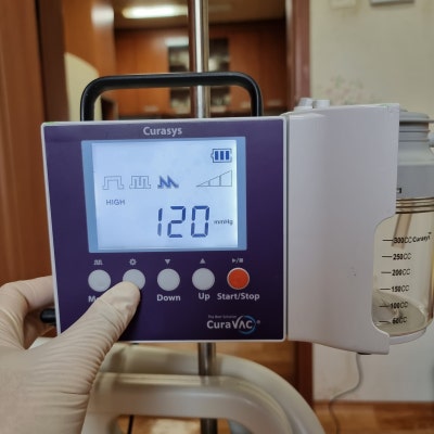 [방문간호] 집에서 욕창음압치료 생생후기 / Curasys / Curavac / NPWT / 큐라시스 / 실제욕창사진주의 ...