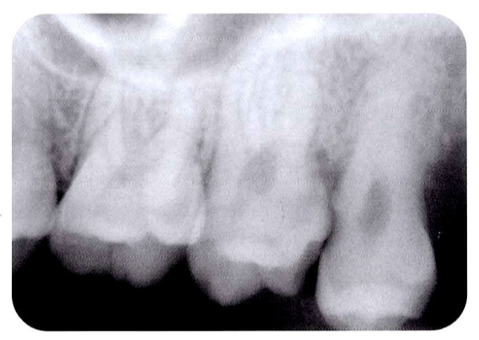 치과 파노라마 사진이 뭐에요? 파노라마 방사선 사진 / Panorama X-ray / Orthopan : 네이버 블로그