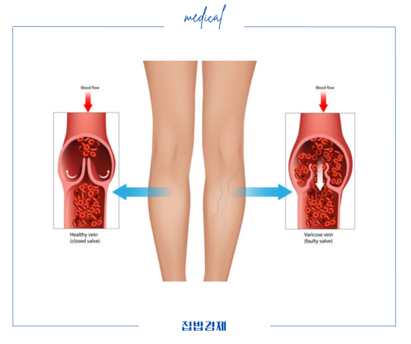 베니톨정 정맥순환개선제 효과 및 부작용과 가격 네이버 블로그