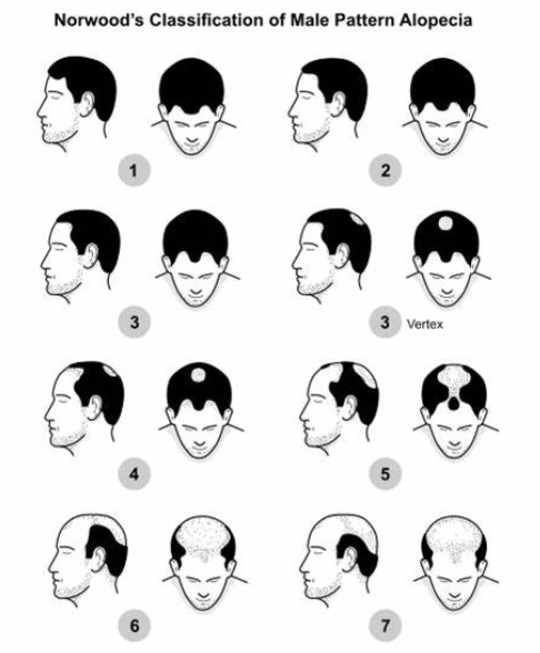 안드로겐 탈모증(남성형, 여성형 탈모) 시리즈 1편 : 네이버 블로그