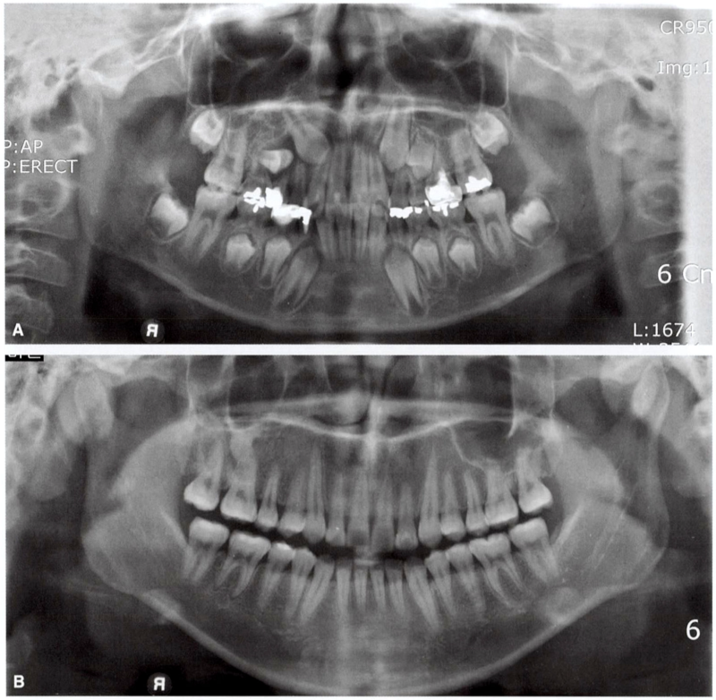 치과 파노라마 사진이 뭐에요? 파노라마 방사선 사진 / Panorama X-ray / Orthopan : 네이버 블로그