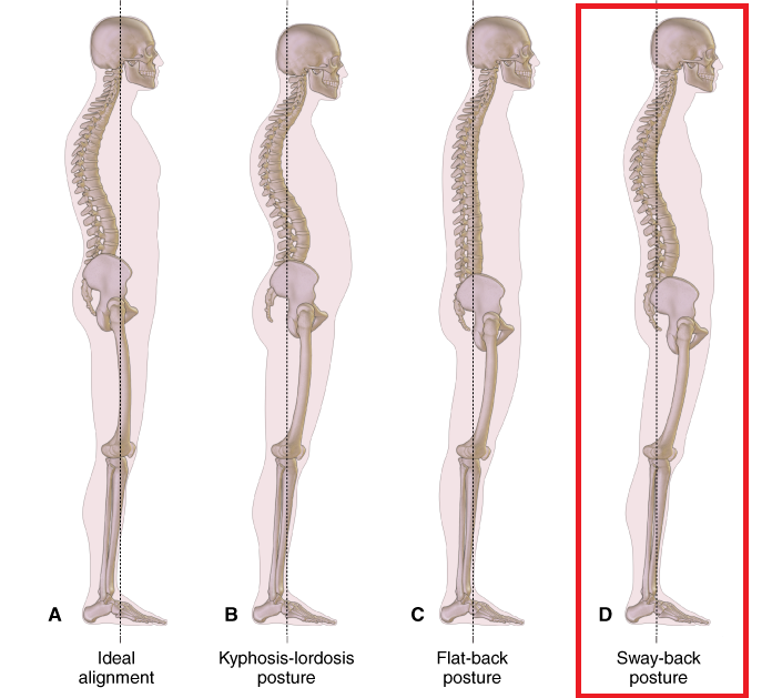 잠실PT) 석촌PT) "굽은등(Sway back)"자세에 대해 알아보자! : 네이버 블로그