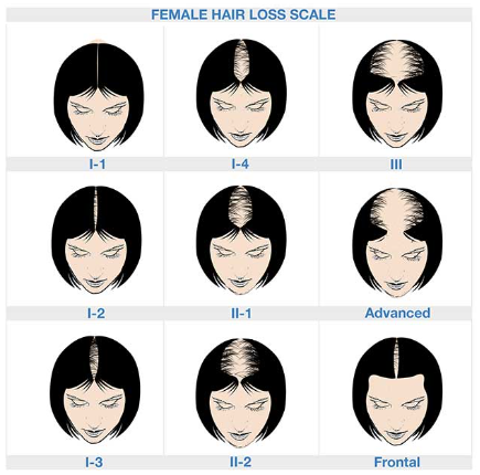 안드로겐 탈모증(남성형, 여성형 탈모) 시리즈 1편 : 네이버 블로그