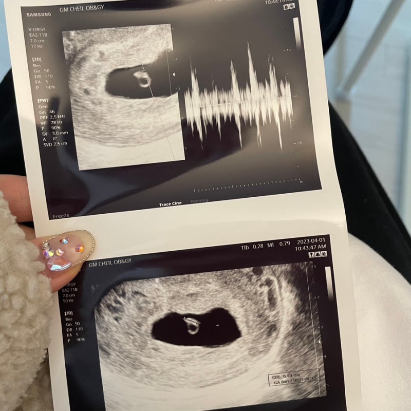 임신초기 계류유산 소파술 후기 그리고 마음 몸관리 네이버 블로그