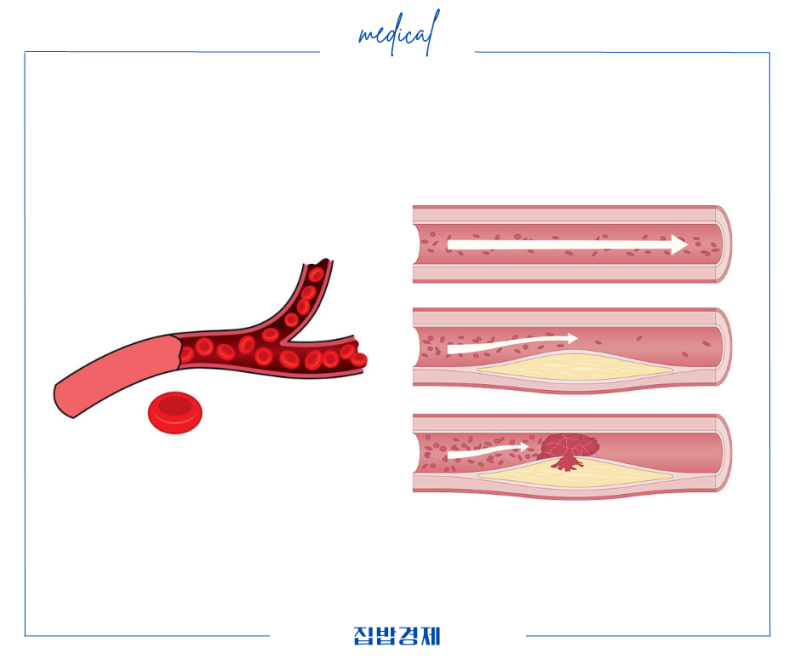 아스피린프로텍트정100mg 혈전약 효과 및 부작용 알아보기 네이버 블로그