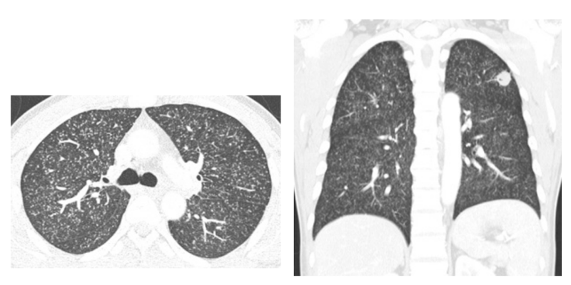활동성 폐결핵 폐엑스레이 증례 속립 결핵 폐경화 결핵종 X Ray 네이버 블로그