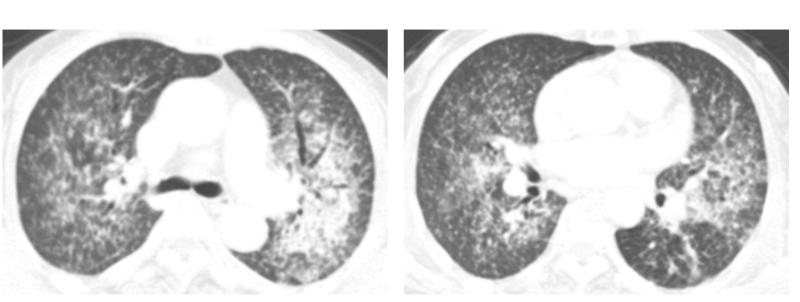 활동성 폐결핵 폐엑스레이 증례 속립 결핵 폐경화 결핵종 X Ray 네이버 블로그