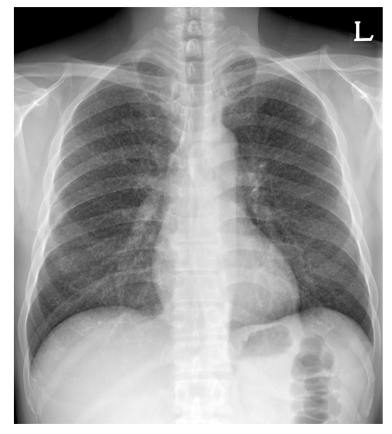활동성 폐결핵 폐엑스레이 증례 속립 결핵 폐경화 결핵종 X Ray 네이버 블로그