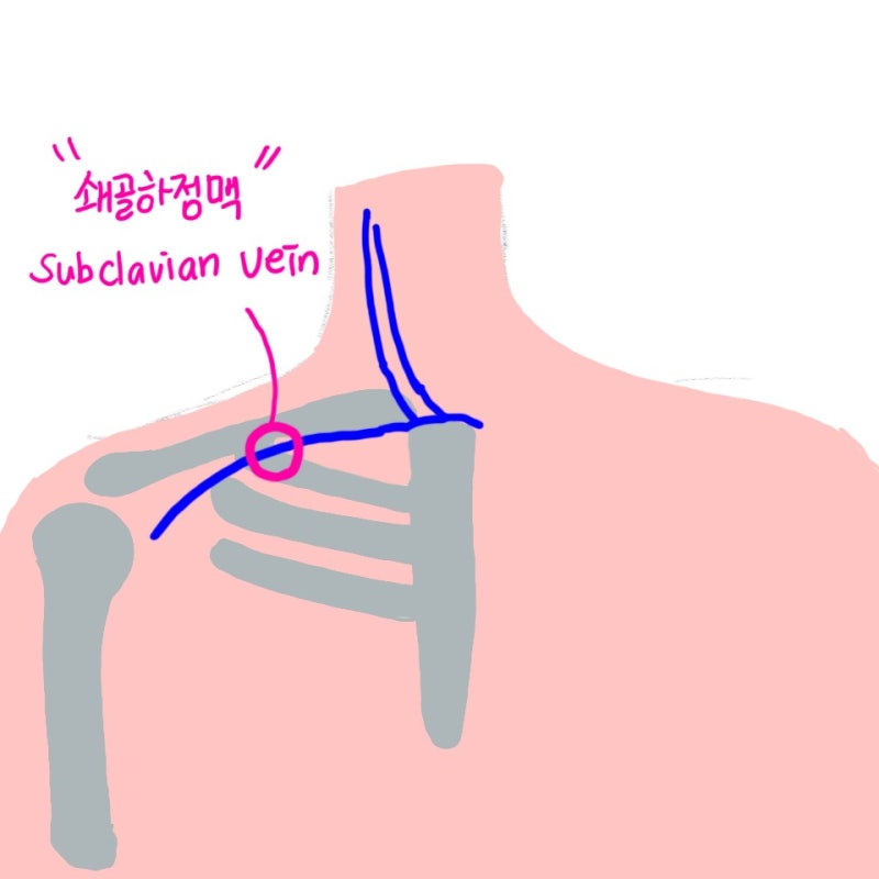 C Line Central Venous Catheter 중심정맥관 삽입 위치 Jugularsubclavianfemoral