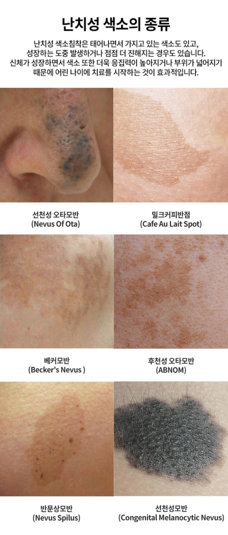 대치동피부과카페오레반점밀크커피반점 저출력 레이저 치료 효과 네이버 블로그