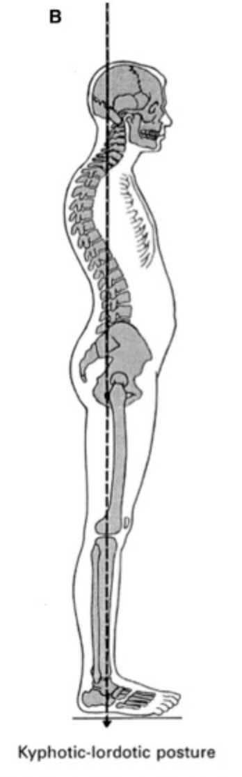 켄달의 체형 분류, 자세 유형 (Kendall's Postural Types) : 네이버 블로그