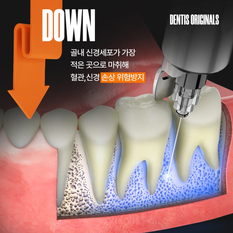 [ORIGINALS] 치과 마취 통증? 이젠 BYE🖐🏻 세계 최초! 덴티스 포터블 골내 무통마취기, DENOPS-i : 네이버 블로그