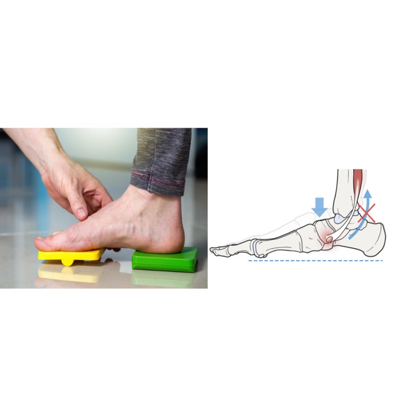 부주상골증후군 부주상골 증후군 원인 부주상골 증후군 증상 치료 수술 부주상골증후군 군대 네이버 블로그