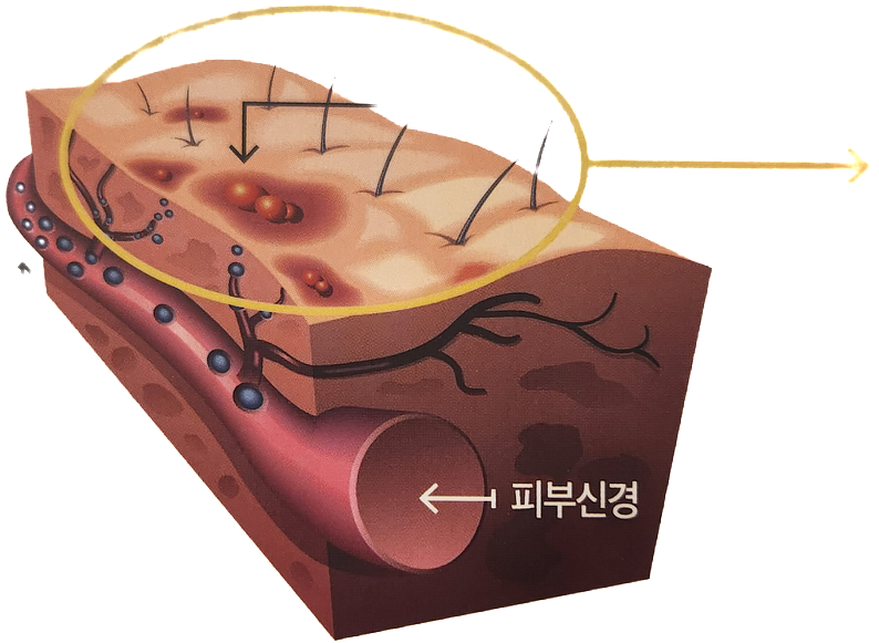 대상포진예방접종 이제는 예방율98 높은 싱그릭스로 접종하세요 네이버 블로그