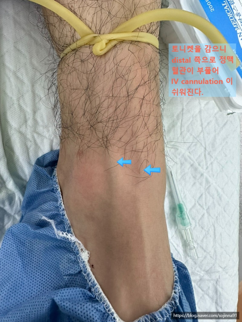 정맥 주사 (IV cannula) 잡는 법, Angio-needle 색깔, 사이즈, 주입속도까지.( Gauge 게이지 ...