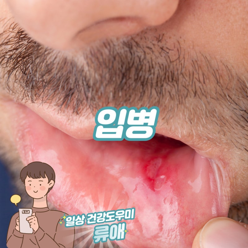 입병 증상 및 원인 입병낫는법 입병약 알보칠 가격 및 사용법 고통 후기 네이버 블로그