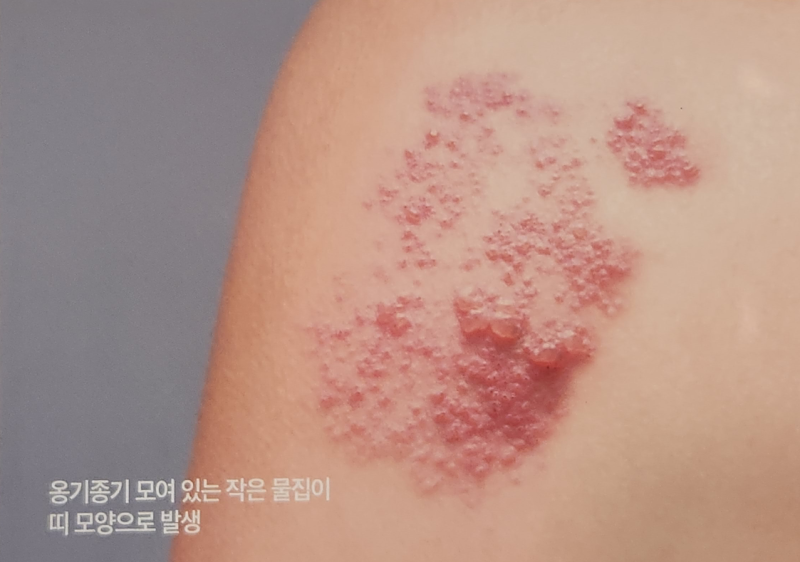 대상포진예방접종 이제는 예방율98 높은 싱그릭스로 접종하세요 네이버 블로그