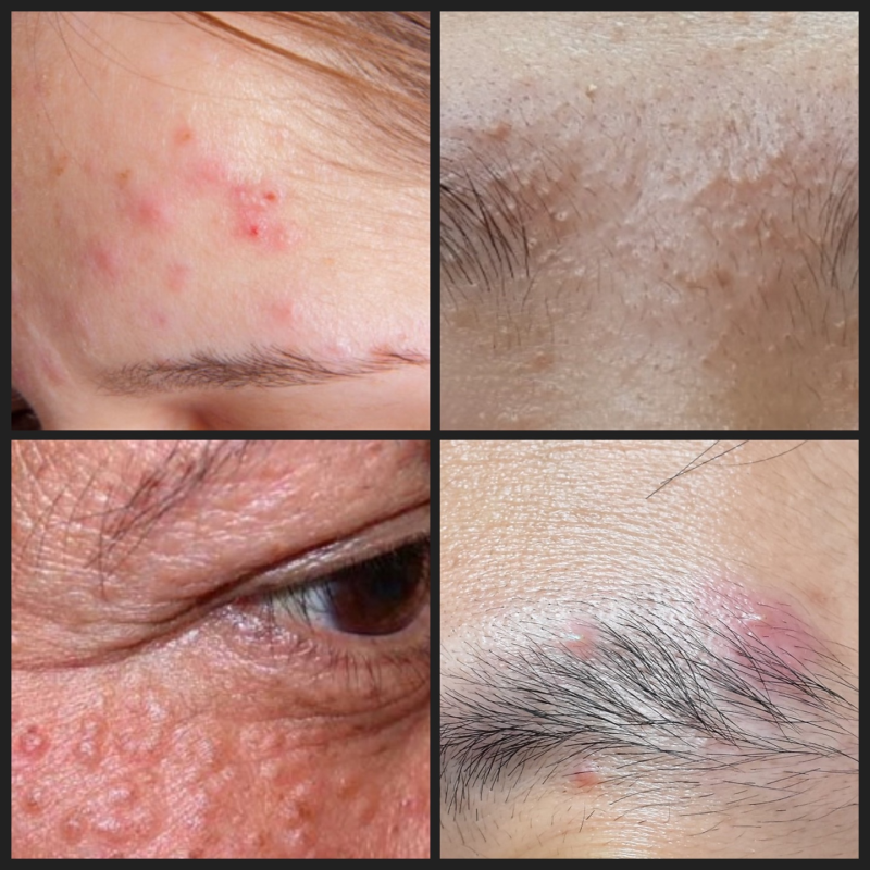 성인 얼굴 이마 미간 사이 눈썹 눈밑에 좁쌀여드름 면포성 여드름 뾰루지 원인 및 없애는 법 네이버 블로그