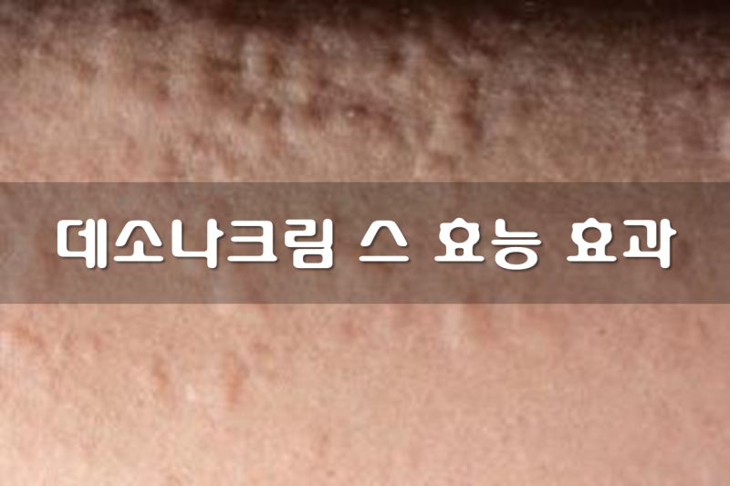 데소나크림 005 염증 가려움증 스테로이드 데소나 효능 용법 부작용 주의사항 가격 네이버 블로그