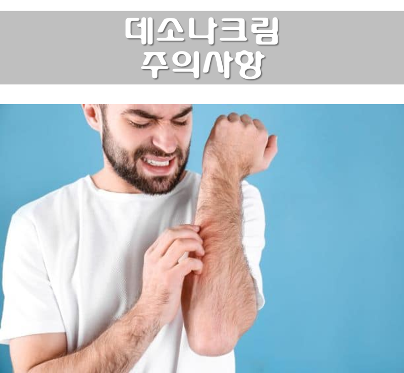 데소나크림 005 염증 가려움증 스테로이드 데소나 효능 용법 부작용 주의사항 가격 네이버 블로그