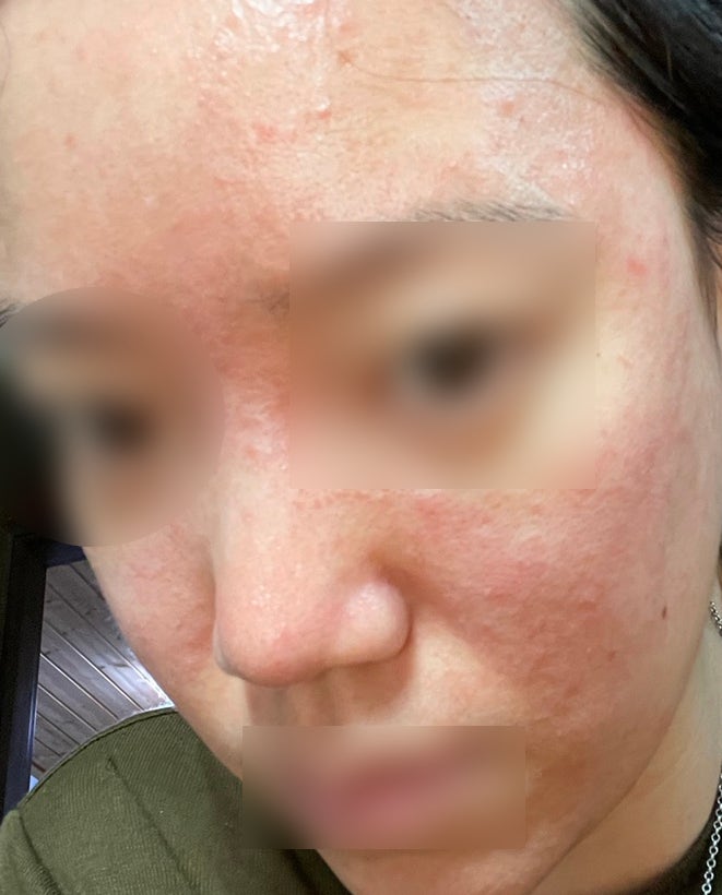주사피부염 극복을 도와준 인생 기초템들 추천 네이버 블로그