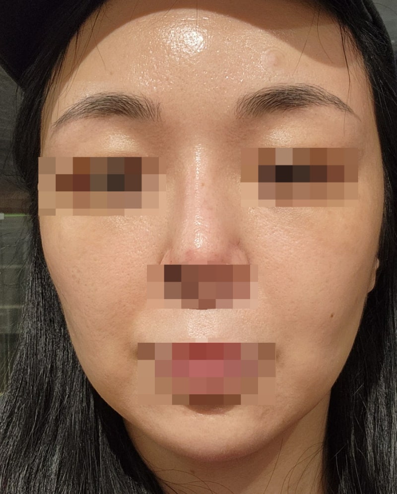 주사피부염 완치 및 재발 방지를 위한 생활습관 만들기 Doanddont 네이버 블로그