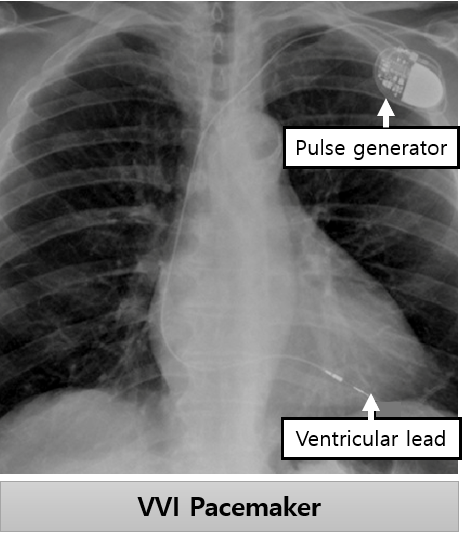 인공 심박동기 (permanent pacemaker) 개념과 해석 총정리, mode DDD, VVI, AAI와 PPM, TPM ...