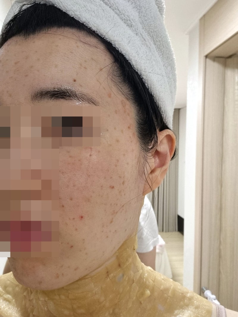 합정 편평사마귀 레이저 제거 후기1~3일차 얼굴and목 네이버 블로그