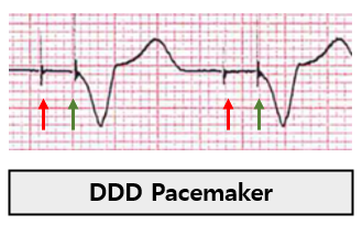 인공 심박동기 (permanent pacemaker) 개념과 해석 총정리, mode DDD, VVI, AAI와 PPM, TPM ...