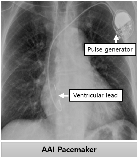 인공 심박동기 (permanent pacemaker) 개념과 해석 총정리, mode DDD, VVI, AAI와 PPM, TPM ...