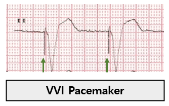 인공 심박동기 (permanent pacemaker) 개념과 해석 총정리, mode DDD, VVI, AAI와 PPM, TPM ...