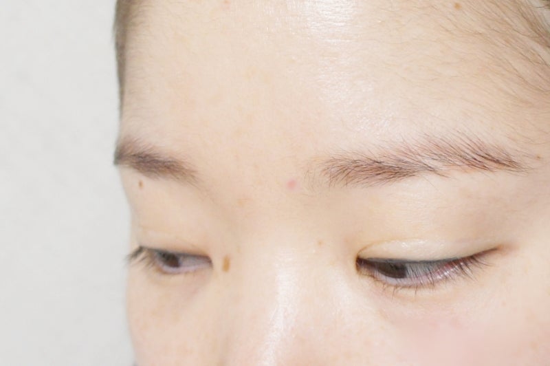 뾰루지 미간 여드름 원인 찾아보고 낫츠 센텔라스카 연고 사용해봄 네이버 블로그