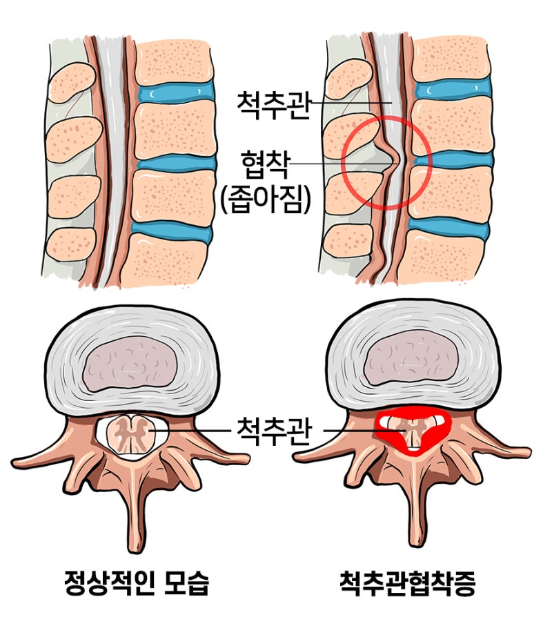 척추관협착증 증상 및 치료방법은 신경성형술 풍선확장술 신경차단술 Feat 척추센터 서진석 원장 네이버 블로그