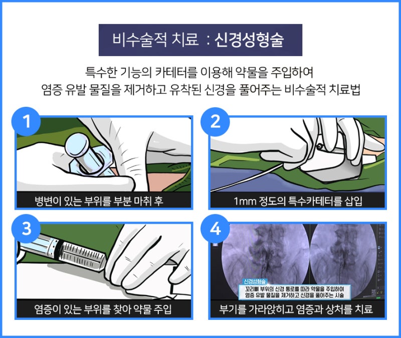척추관협착증 증상 및 치료방법은 신경성형술 풍선확장술 신경차단술 Feat 척추센터 서진석 원장 네이버 블로그