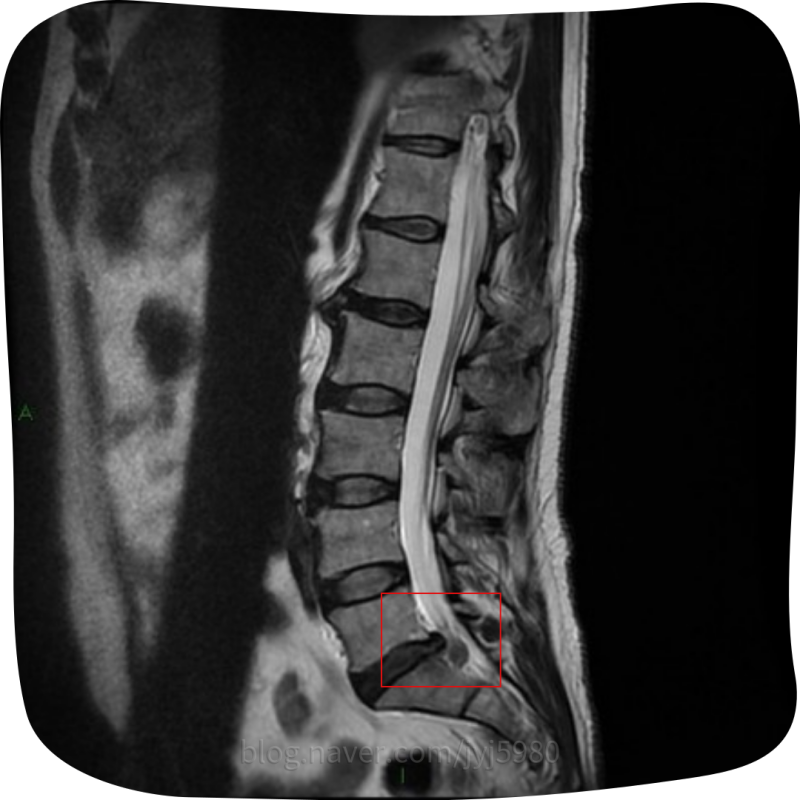 목, 허리 MRI 촬영했더니 Bulging disc, Protrusion, Extrusion, Sequestration 무엇을 ...