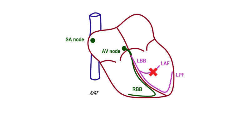Left anterior fascicular block (좌각 전섬유속 차단, LAFB) : 네이버 블로그