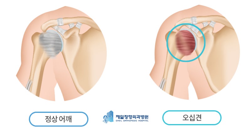 연령별 어깨 질환 10~20대 관절외순 손상 30대 어깨충돌증후근 40~50대 석회성건염 오십견 60대 회전근개
