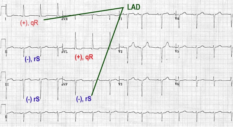 Left anterior fascicular block (좌각 전섬유속 차단, LAFB) : 네이버 블로그