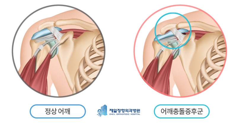 연령별 어깨 질환 10~20대 관절외순 손상 30대 어깨충돌증후근 40~50대 석회성건염 오십견 60대 회전근개