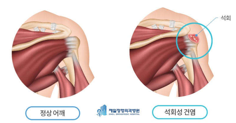 연령별 어깨 질환 10~20대 관절외순 손상 30대 어깨충돌증후근 40~50대 석회성건염 오십견 60대 회전근개