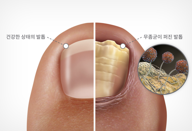 에스로반 연고 사용법 And 주의사항 무좀 모낭염 여드름 부작용 상처 무피로신 스테로이드 네이버 블로그