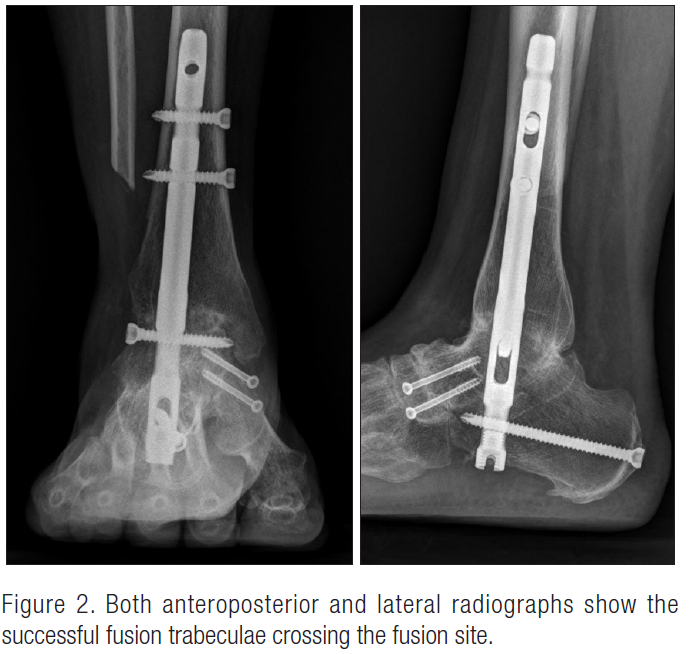 Ankle-Arthrodesis (AA) Tibio-talar fusion 발목관절 유합술 : 네이버 블로그