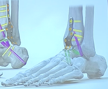 Ankle-Arthrodesis (AA) Tibio-talar fusion 발목관절 유합술 : 네이버 블로그